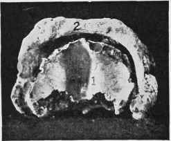Chronic Periostitis