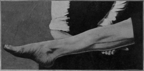 (i.) The Mechanical Effect of Massage on the Circulation