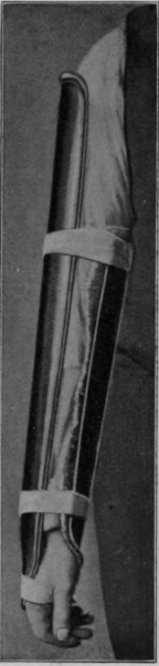 Fractures of the Upper Extremity Treatment. Part 5