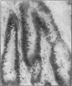 3. Soft Cancers Or Medullary Cancers
