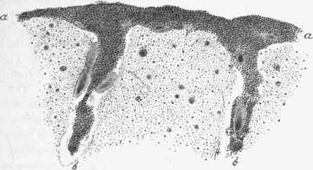 2. Leptomeningitis. Inflammation Of The Pia-Arachnoid
