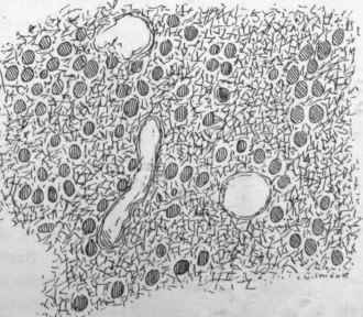 VIII. Tumours And Parasites Of The Brain