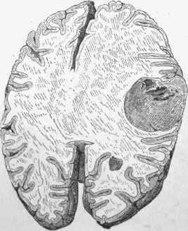 VIII. Tumours And Parasites Of The Brain