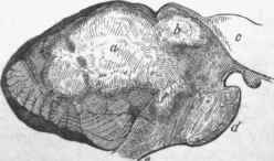 1. Tubercular Tumour Of The Brain (Scrofulous Tubercle Of The Brain)