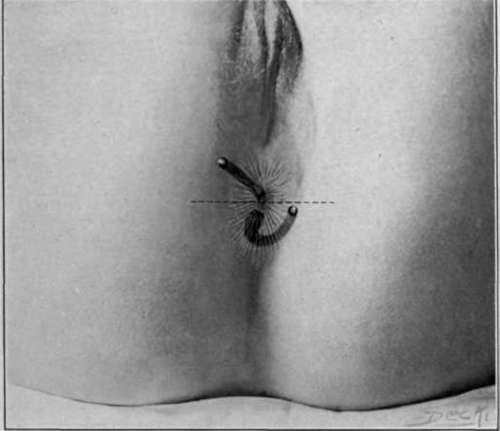Fistulae. Part 2
