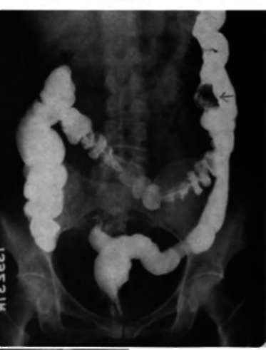 X-Ray Studies of Of The Colon And/Or Rectum Cancer