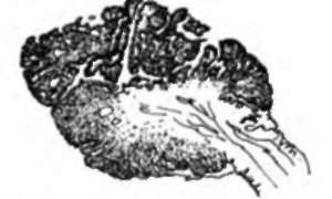 Classification Of Polyps