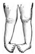 Club Foot - Deformities Of The Hands And Feet