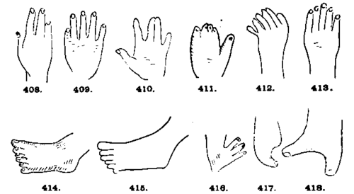 Deformities Of The Hands And Feet